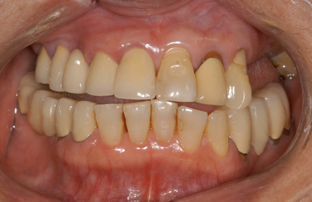 Full Arch (Upper) Restoration - Dallas Dental Implant Center