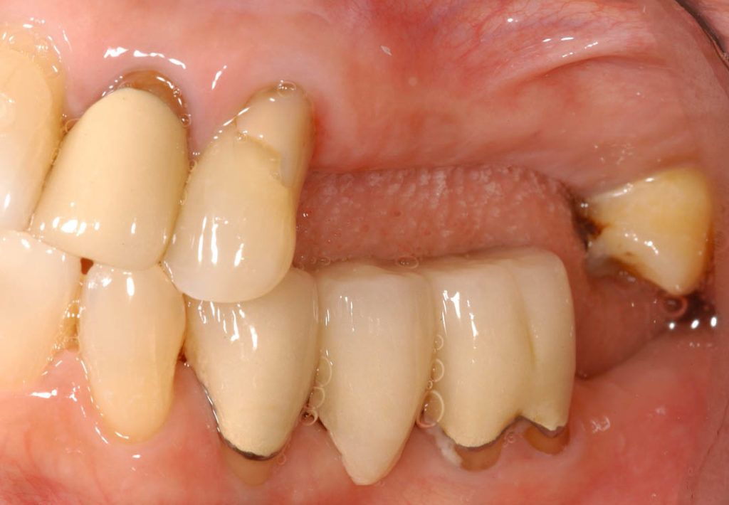 Full Arch (Upper) Restoration - Dallas Dental Implant Center