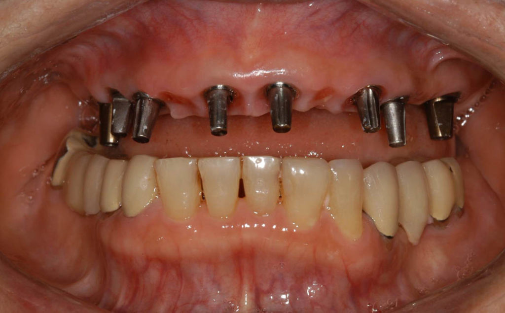 Full Arch (Upper) Restoration - Dallas Dental Implant Center