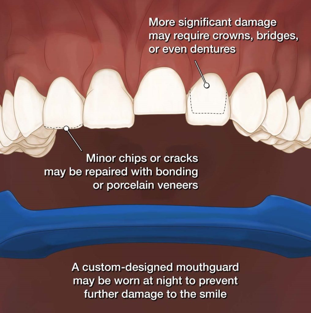 ALL ABOUT BRUXISM (TOOTH GRINDING) - Dallas Dental Implant Center